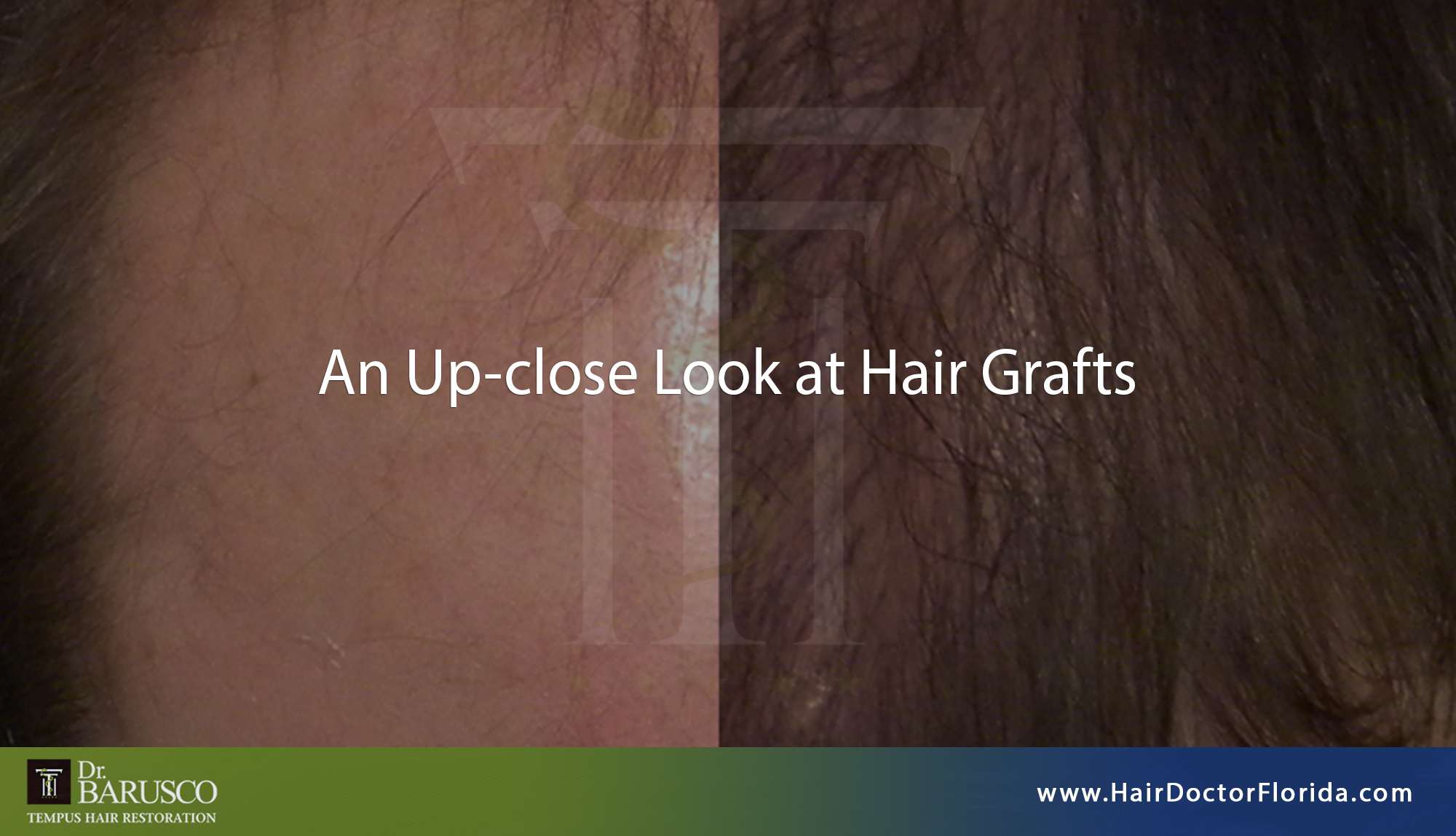 An Up-close Look at Hair Grafts - Tempus Hair